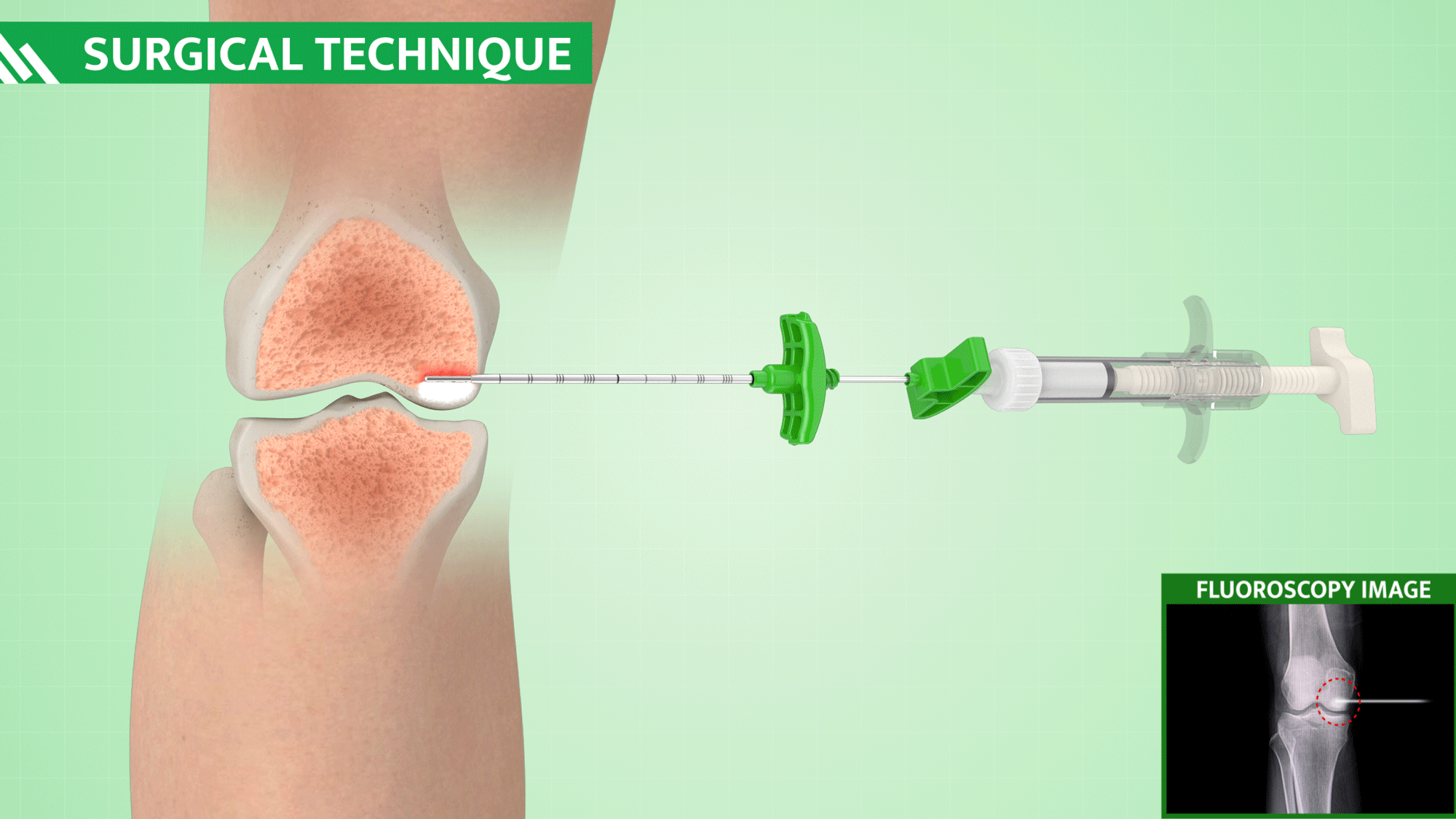 ORTHOPLASTY™ subchondral bone plasty - BPB medica