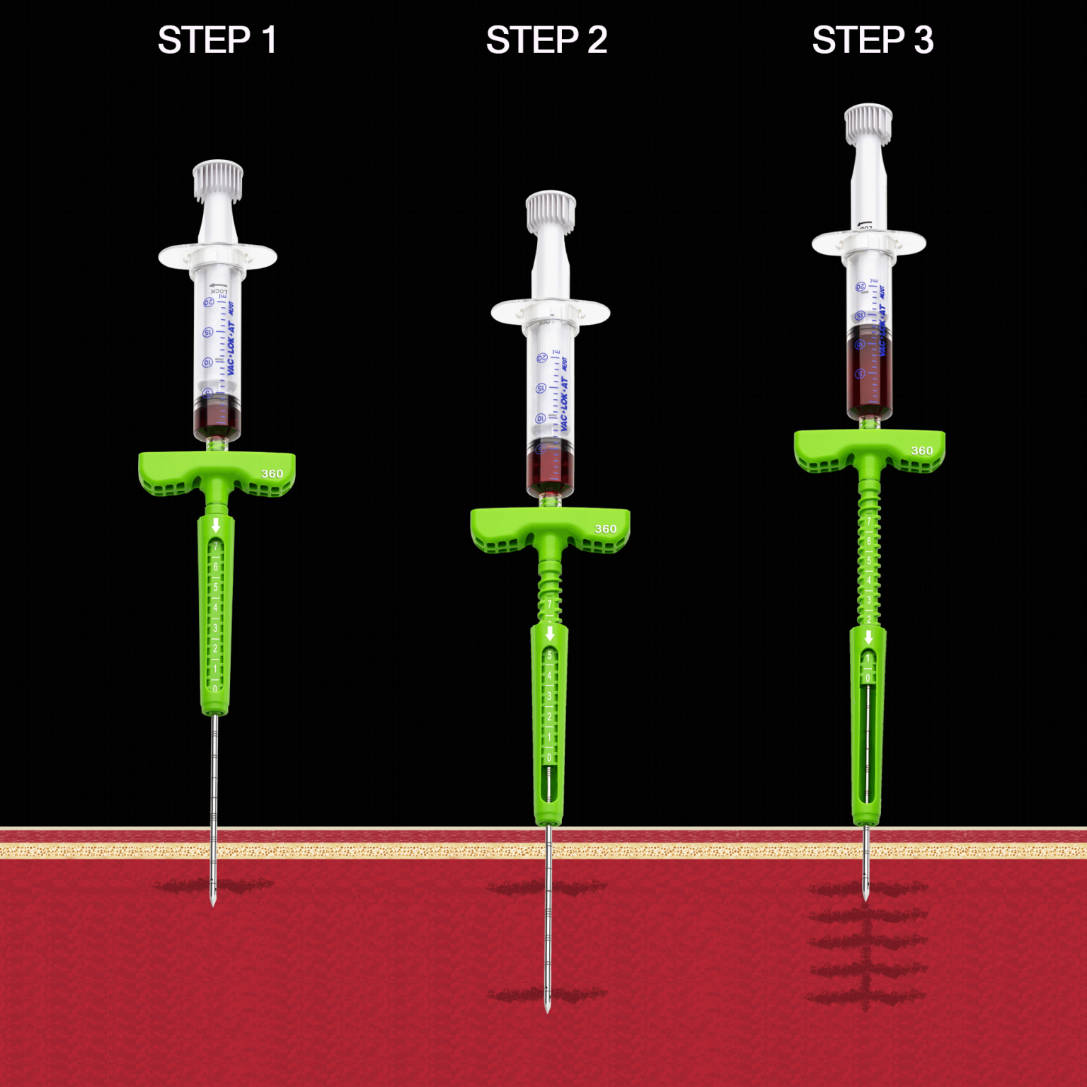 MARROW-STEM™ bone marrow mesenchymal stem cells aspiration kit - BPB medica