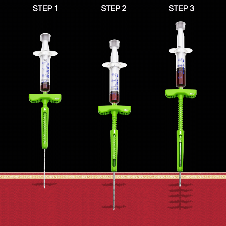 BONESTEM™ bone marrow mesenchymal stem cells aspiration kit - BPB medica