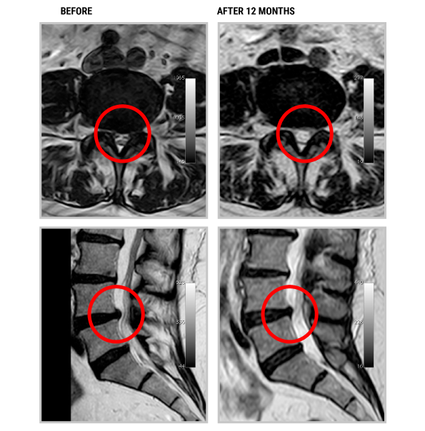 Discectomy Before And After