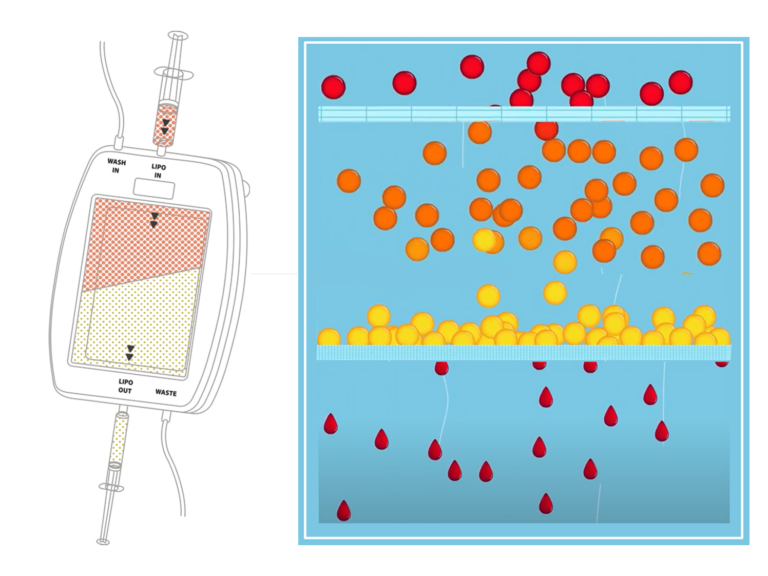 Enhanced Adipose Tissue Processing for Orthopaedics: LIPO-STEM DUO ...