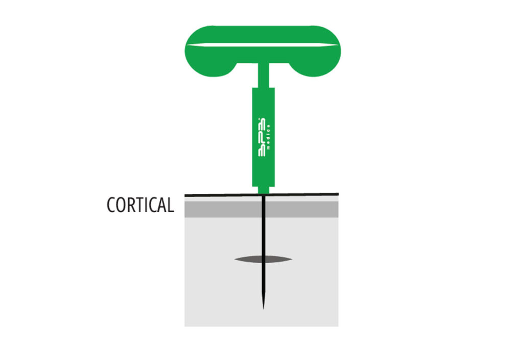 BONE MARROW MSCs SELECTIVE ASPIRATION - BPB medica