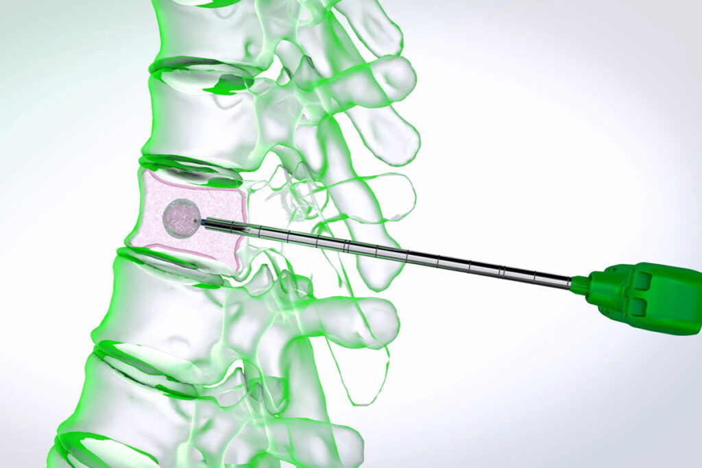 KYPHOPLASTY PROCEDURE - BPB medica
