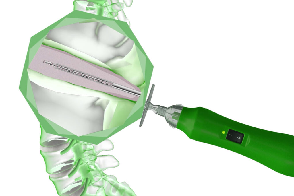 PERCUTANEOUS DISCECTOMY - BPB medica