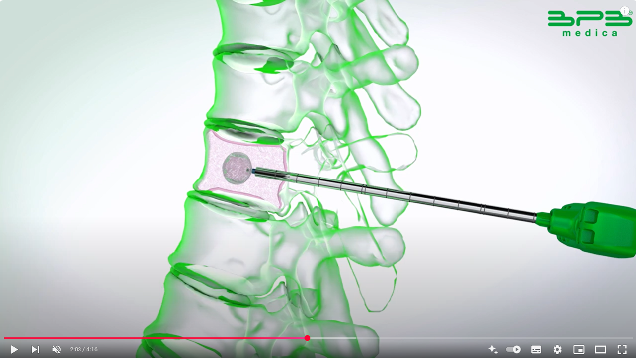 KYPHOPLASTY PROCEDURE - BPB medica