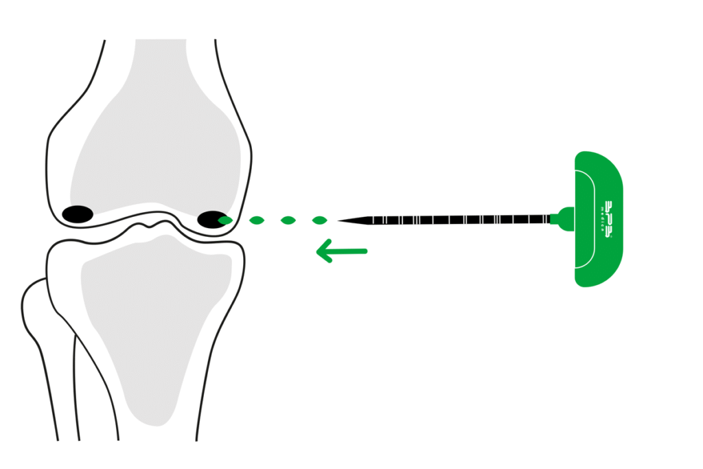 SUBCHONDRAL BONE MARROW LESIONS TREATMENT - BPB medica