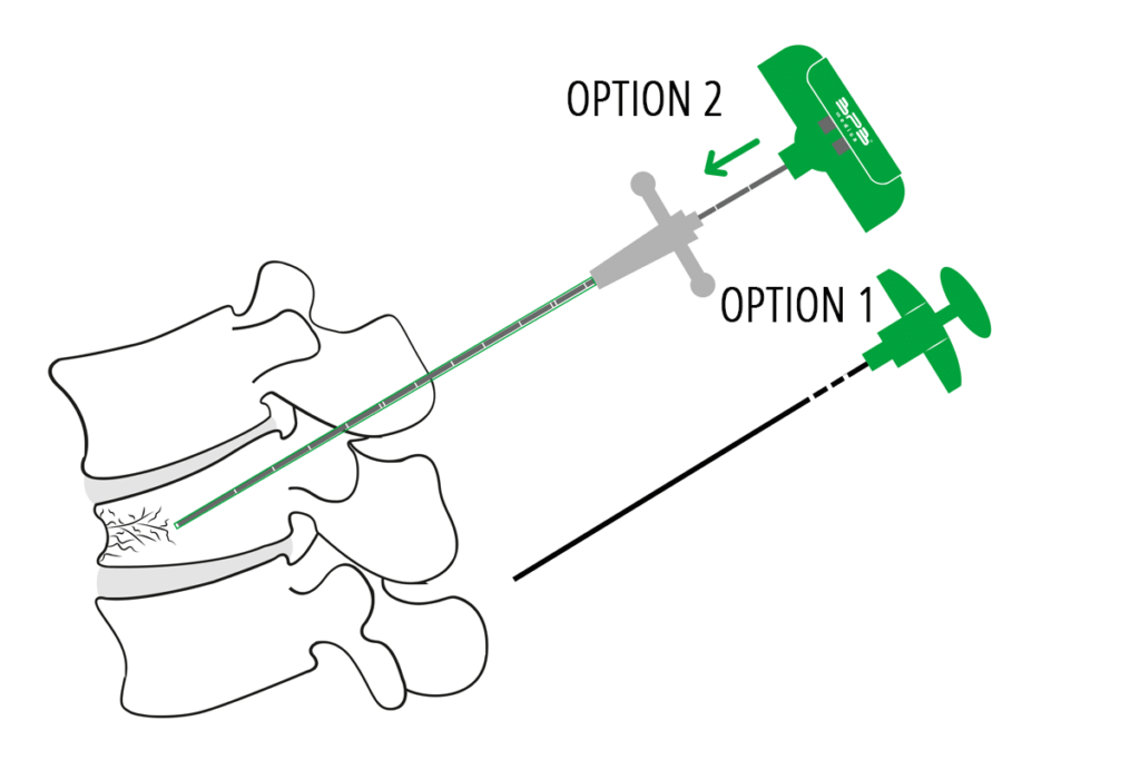 VERTEBRAL BIOPSY PROCEDURE - BPB medica