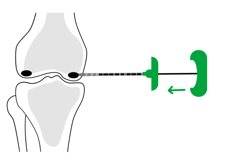 SUBCHONDRAL BONE MARROW LESIONS TREATMENT - BPB medica