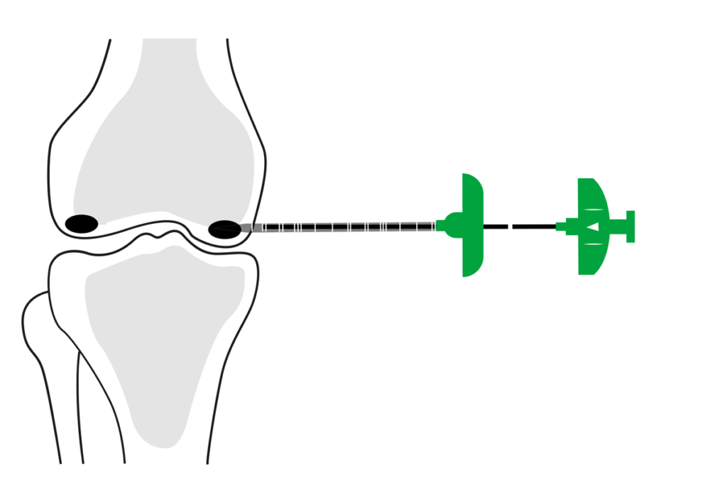 SUBCHONDRAL BONE MARROW LESIONS TREATMENT - BPB medica
