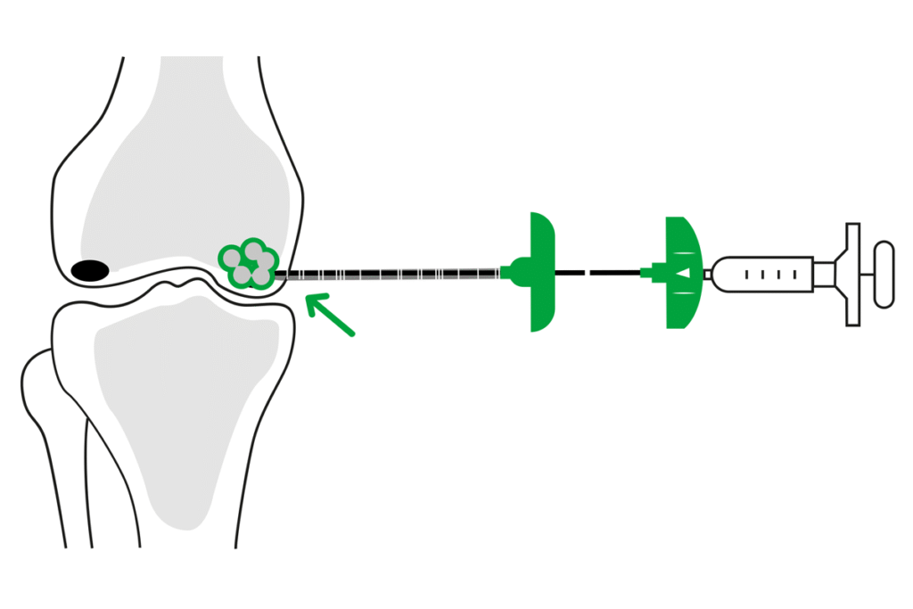 SUBCHONDRAL BONE MARROW LESIONS TREATMENT - BPB medica