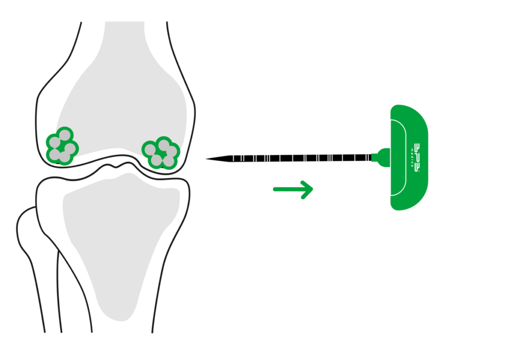 SUBCHONDRAL BONE MARROW LESIONS TREATMENT - BPB medica