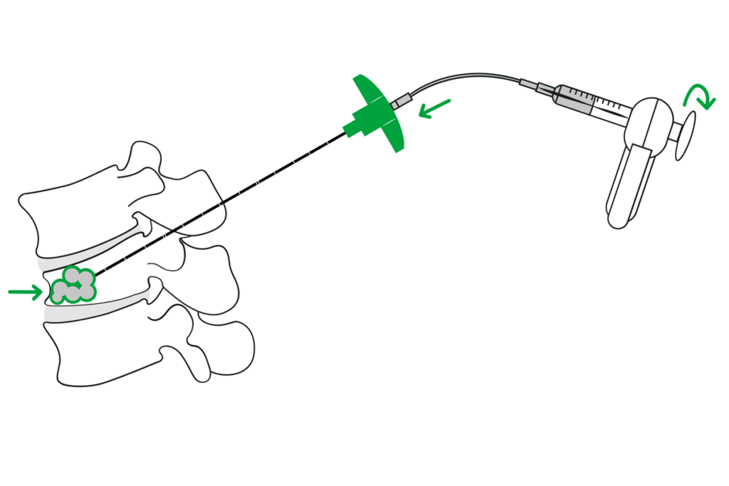 VERTEBROPLASTY PROCEDURE - BPB medica